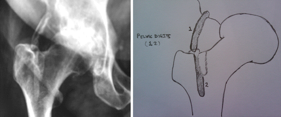 Multiple Pelvic digits: a rare congenital anomaly | SpringerLink