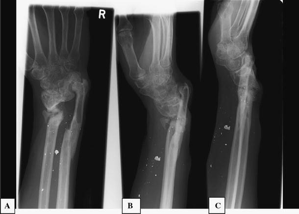 Darrach's ulnar resection and ulna intercalary bone graft for non-union ...