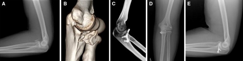 Coronoid plate fixation of type II and III coronoid process fractures ...