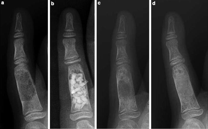Treatment for hand enchondroma with curettage and calcium sulfate ...