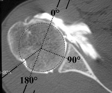 New quantitative measurement of the Hill–Sachs lesion: a prognostic ...