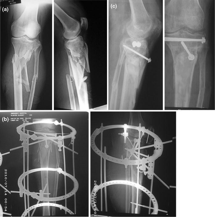 Outcomes of open bicondylar tibial plateau fractures treated with ...