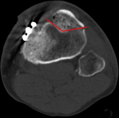 Combined medial open-wedge high tibial osteotomy and modified Maquet ...