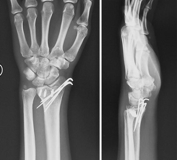 A case of acute dorsal radiocarpal dislocation with radial styloid ...