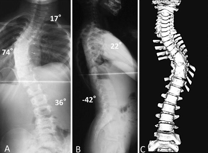 Reconstructive surgery for the post-hemiepiphysiodesis residual ...