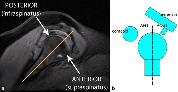 Humeral head cysts: association with rotator cuff tears and age ...