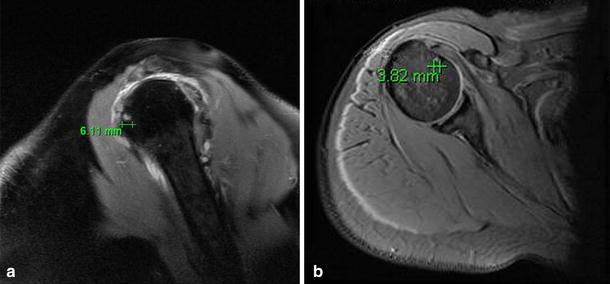 Humeral head cysts: association with rotator cuff tears and age ...