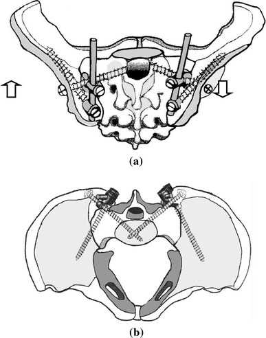 Correction of severe pelvic obliquity using maximum-width segmental ...