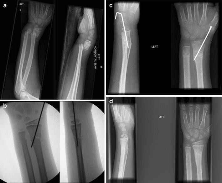 The Outcomes Of Displaced Paediatric Distal Radius Fractures Treated