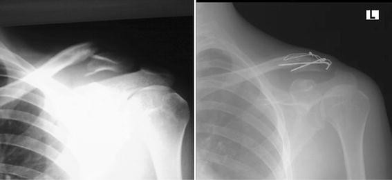 Anatomic locking plate and coracoclavicular stabilization with suture ...
