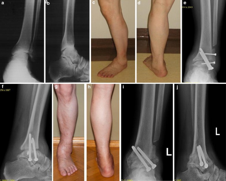 Ankle arthrodesis from lateral transfibular approach: analysis of ...