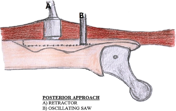 Extended trochanteric osteotomy: current concepts review | SpringerLink