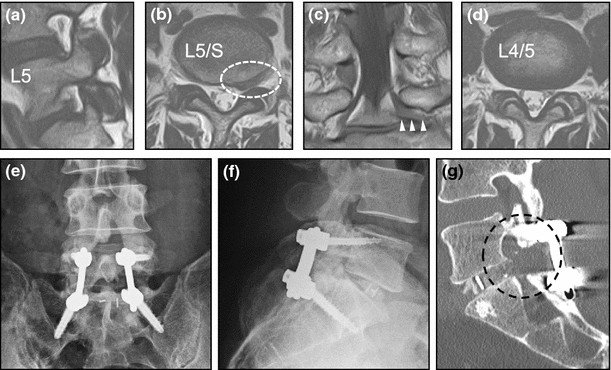 Lumbar foraminal stenosis, the hidden stenosis including at L5/S1 ...