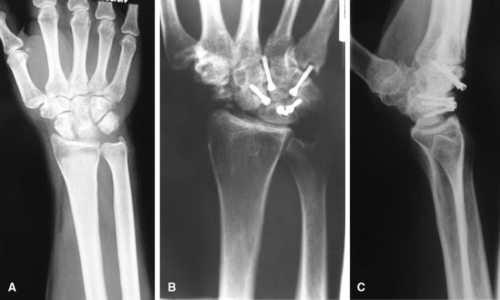 Four-corner fusion of the wrist: clinical and radiographic outcome of ...