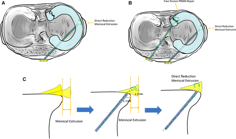 Arthroscopic direct meniscal extrusion reduction: surgical tips to ...