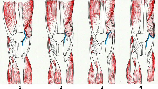 Minimally invasive total knee replacement: techniques and results ...