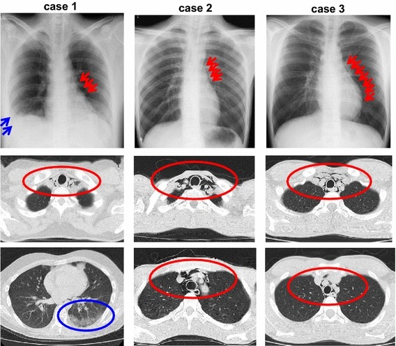 Hamman’s syndrome triggered by the onset of type 1 diabetes mellitus ...