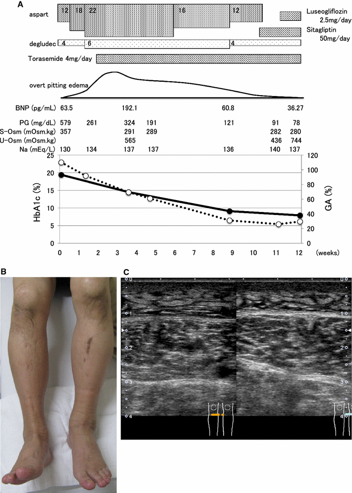 Bilateral lower limb edema induced by rapid improvement of glycemic ...