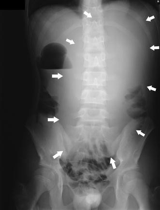 Gastric rupture with necrosis following acute gastric dilatation ...