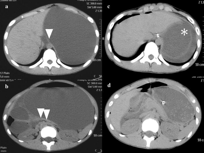 Gastric rupture with necrosis following acute gastric dilatation ...