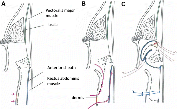 Immediate reconstruction using a modified inframammary adipofascial ...