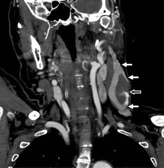 Phlebectasia of the external jugular vein with thrombosis: report of a ...