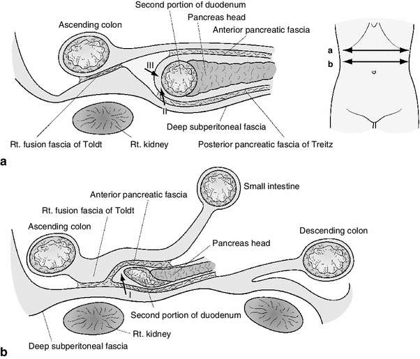 Laparoscopic surgery for colon cancer: a review of the fascial ...
