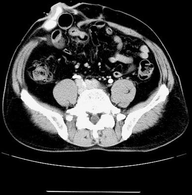 Parastomal hernia repair with the Sugarbaker technique using e-PTFE ...