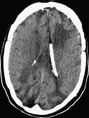 Nocardia brain abscess: severe CNS infection that needs aggressive ...
