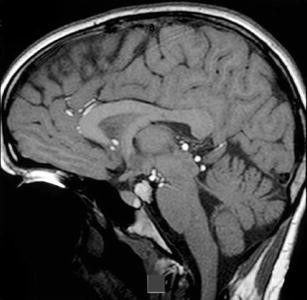 Intracranial dermoid cysts: variations of radiological and clinical ...