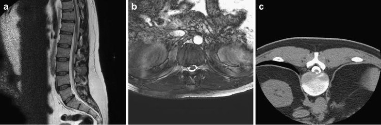 Two brothers with a symptomatic thoracic disc herniation at T11–T12 ...
