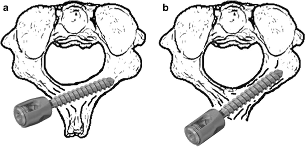 Modification of Wright’s technique for C2 translaminar screw fixation ...
