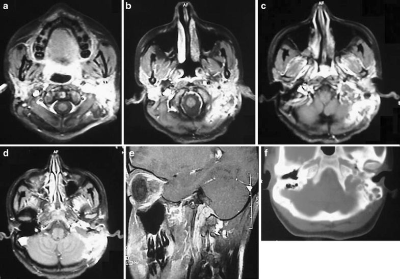 Postauricular, transpetrous, presigmoid approach for extensive skull ...