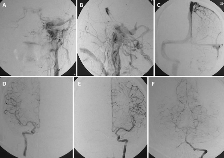Postauricular, transpetrous, presigmoid approach for extensive skull ...