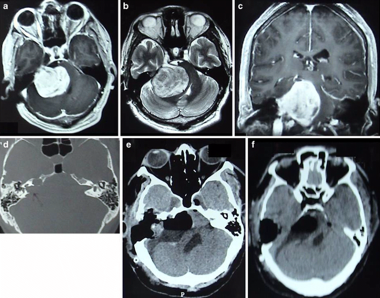 Postauricular, transpetrous, presigmoid approach for extensive skull ...