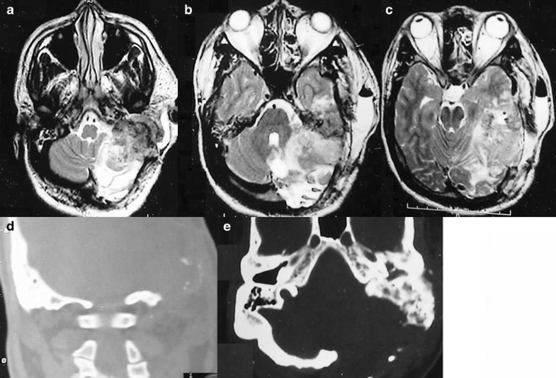 Postauricular, transpetrous, presigmoid approach for extensive skull ...