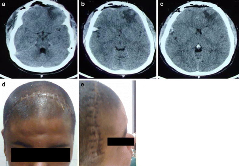 Sinus pericranii with unusual features: multiplicity, associated dural ...