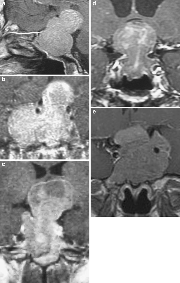 Combined simultaneous transcranial and transsphenoidal resection of ...