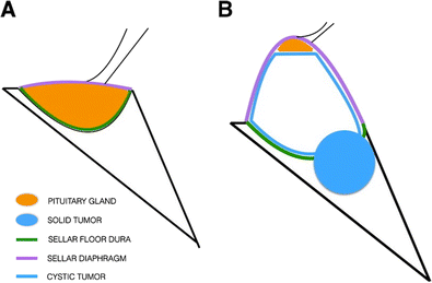 Full endoscopic endonasal transsellar-transclival approach: the ...