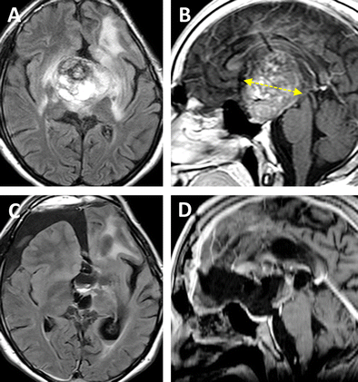 Predicting the necessity of anterior communicating artery division in ...