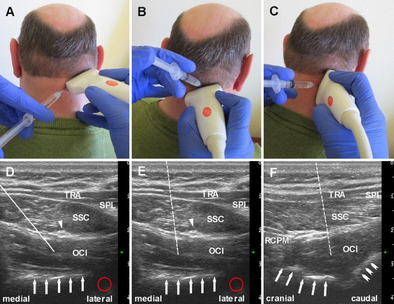 A simplified ultrasonography-guided approach for neurotoxin injection ...