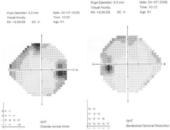 Patient with idiopathic intracranial hypertension with progressive ...