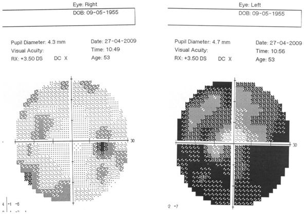 Patient with idiopathic intracranial hypertension with progressive ...