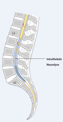 Interventionelle Verfahren in der Tumorschmerztherapie | SpringerLink