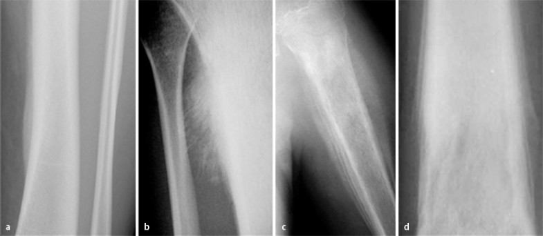 Knochentumoren aus der Sicht des Radiologen | SpringerLink