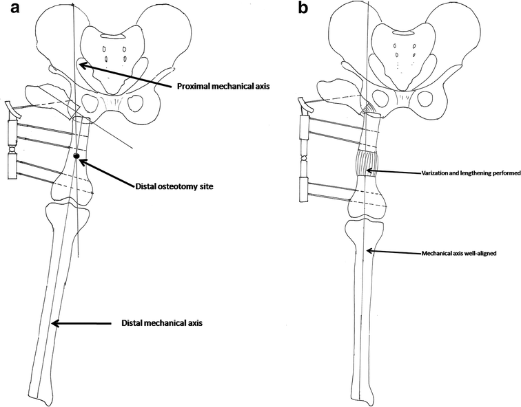 Pelvic support osteotomy for unstable hips using hybrid external ...