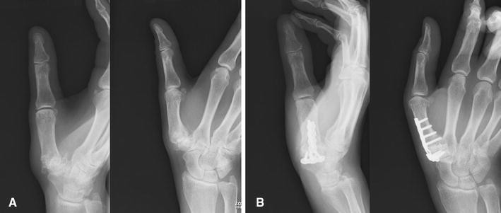 Arthrodesis of the carpometacarpal joint of the thumb with plate ...