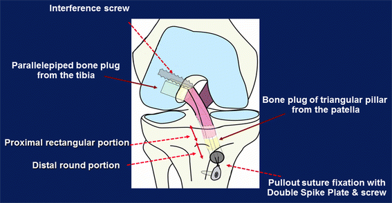 Anatomic ACL reconstruction: rectangular tunnel/bone–patellar tendon ...