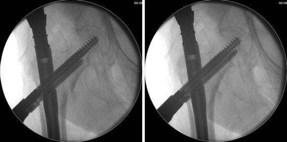 Do PFNA devices and Intertan nails both have the same effects in the ...