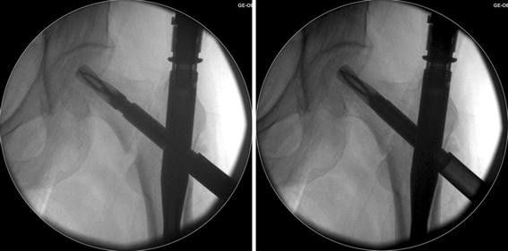 Do PFNA devices and Intertan nails both have the same effects in the ...